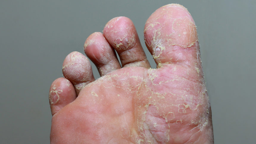 Tinea - Morecroft's Podiatry Services, Lilydale